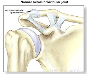 Acromioclavicular Joint Dislocation