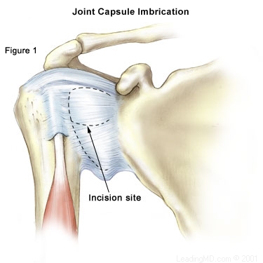 Shoulder Instability