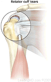 Rotator Cuff / Impingement