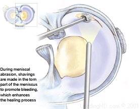 Knee Meniscus Tear Easy Explained OrthoFixar 2023, 58% OFF