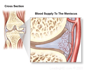 Meniscus Injuries